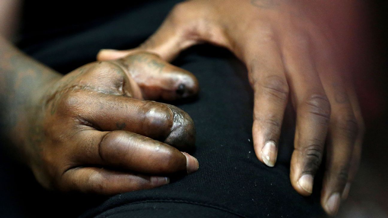Jason Pierre-Paul on mangled hand: Like watching a movie - ESPN